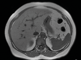 O papel da ressonância magnética no manejo da doença hepática gordurosa ...