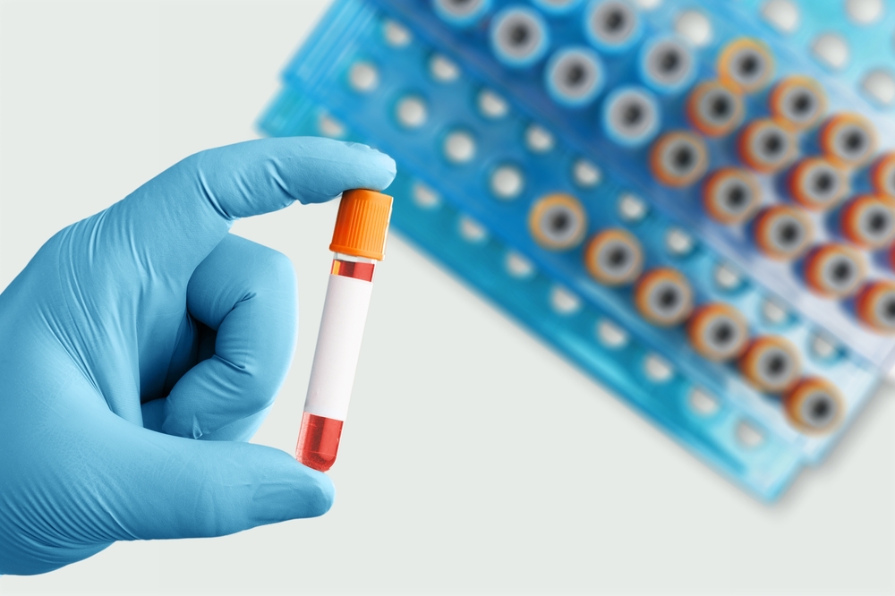 Exame PSA livre: como é feito, resultados e importância › Notícias | a+ ...